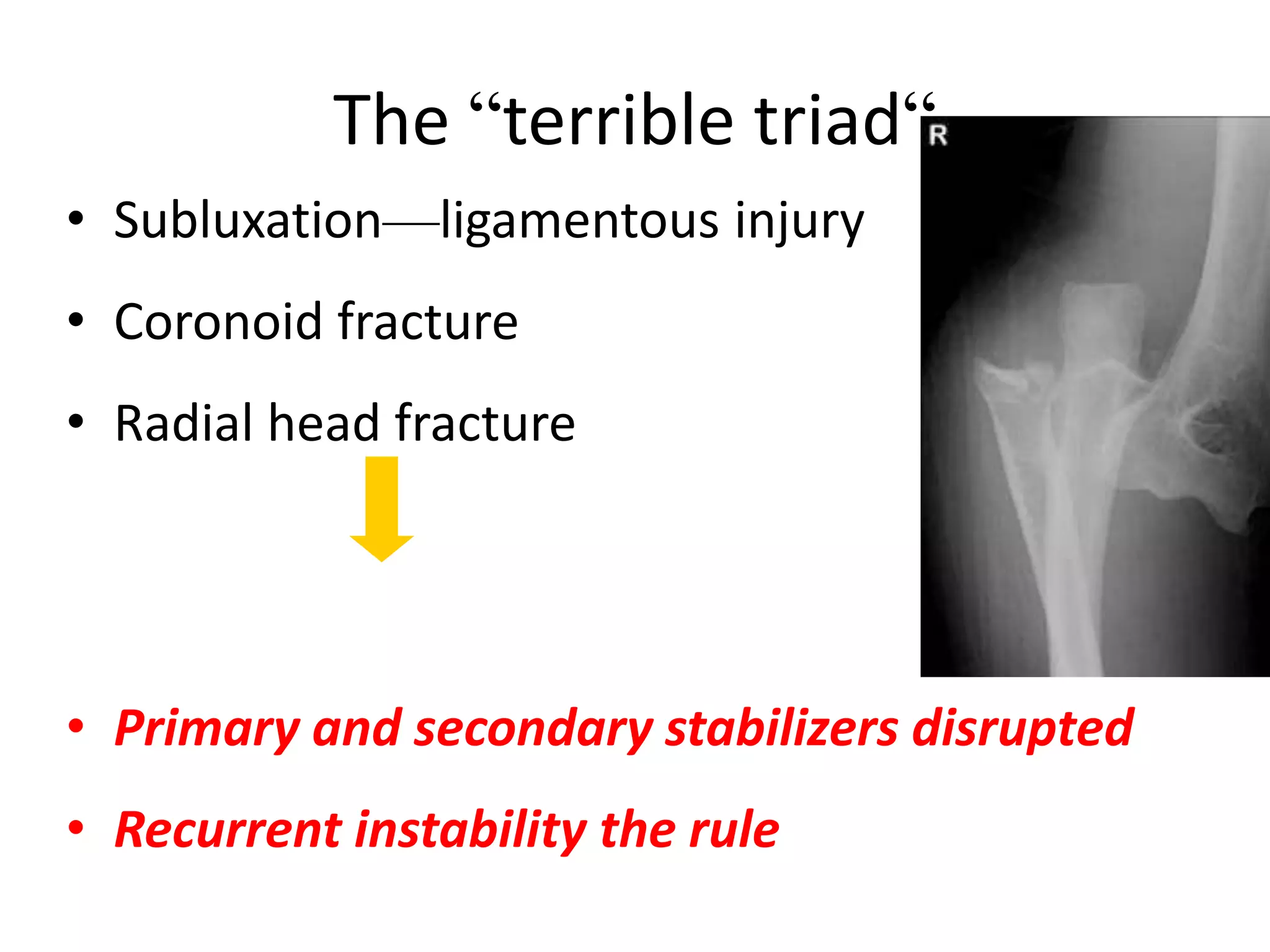 Terrible triad - elbow | PPTX