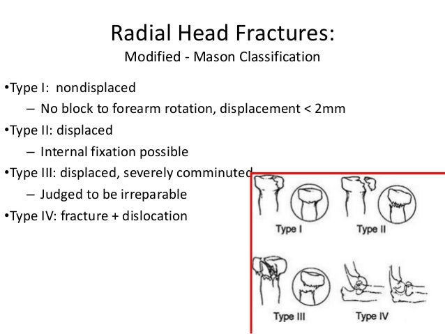 Radial Head Fracture Classification