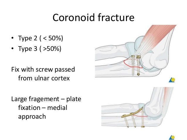 Terrible triad - elbow