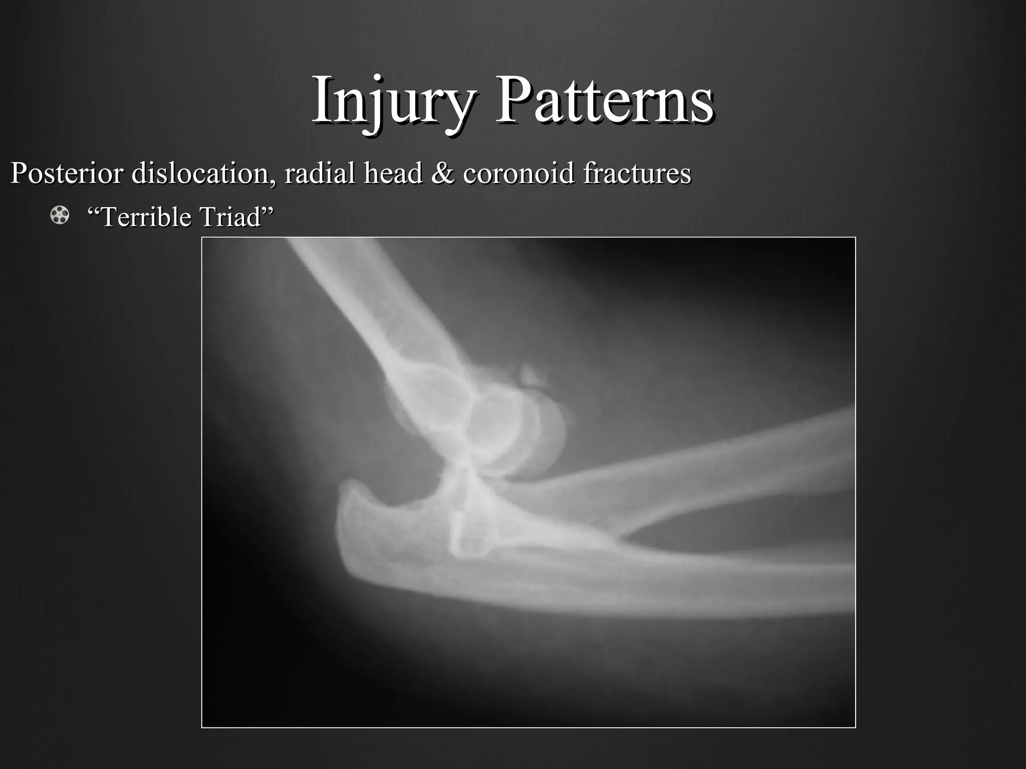 Terrible triad injuries - Hussain Algawahmed | PPT