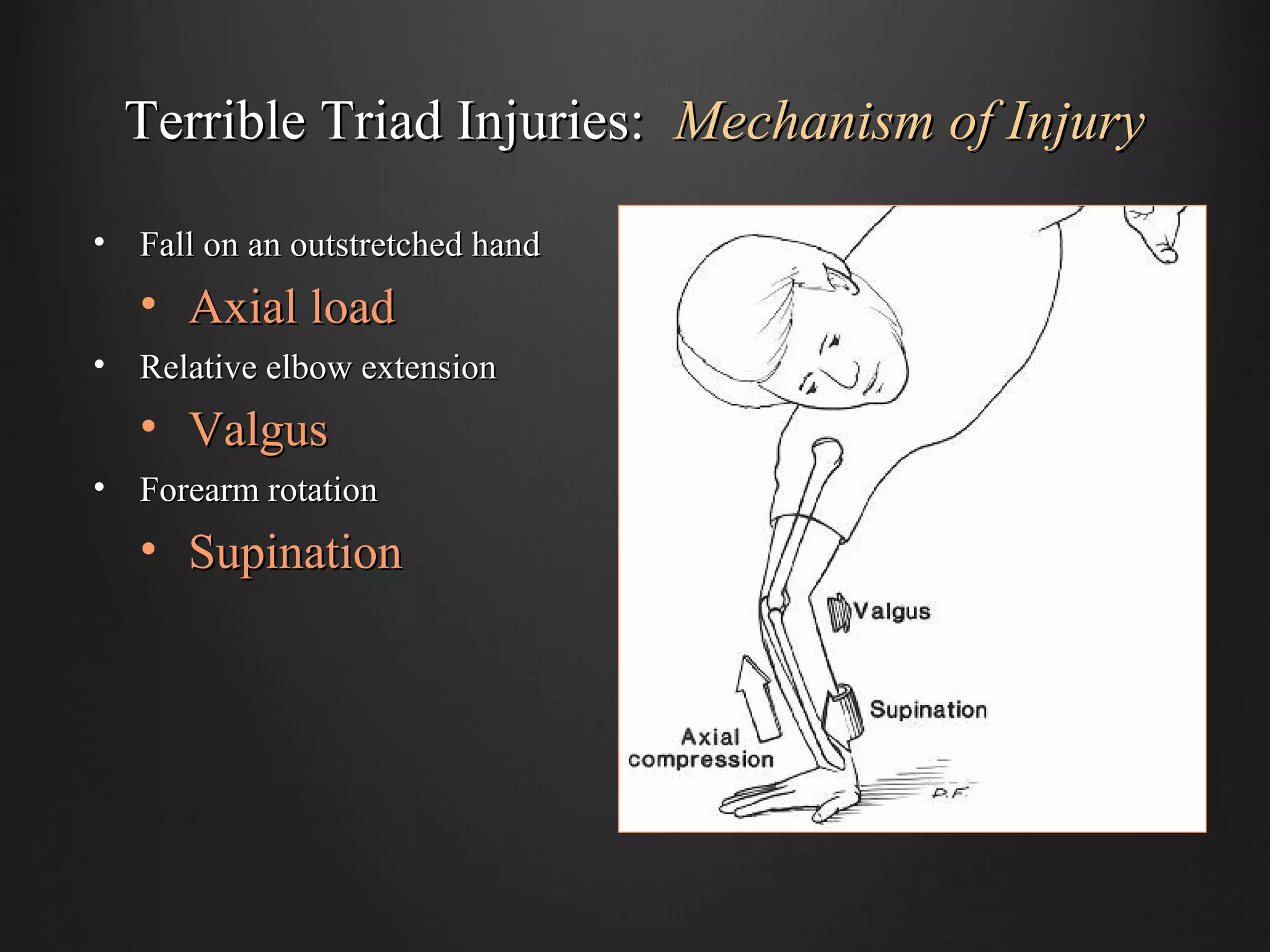 Terrible triad injuries - Hussain Algawahmed | PPT