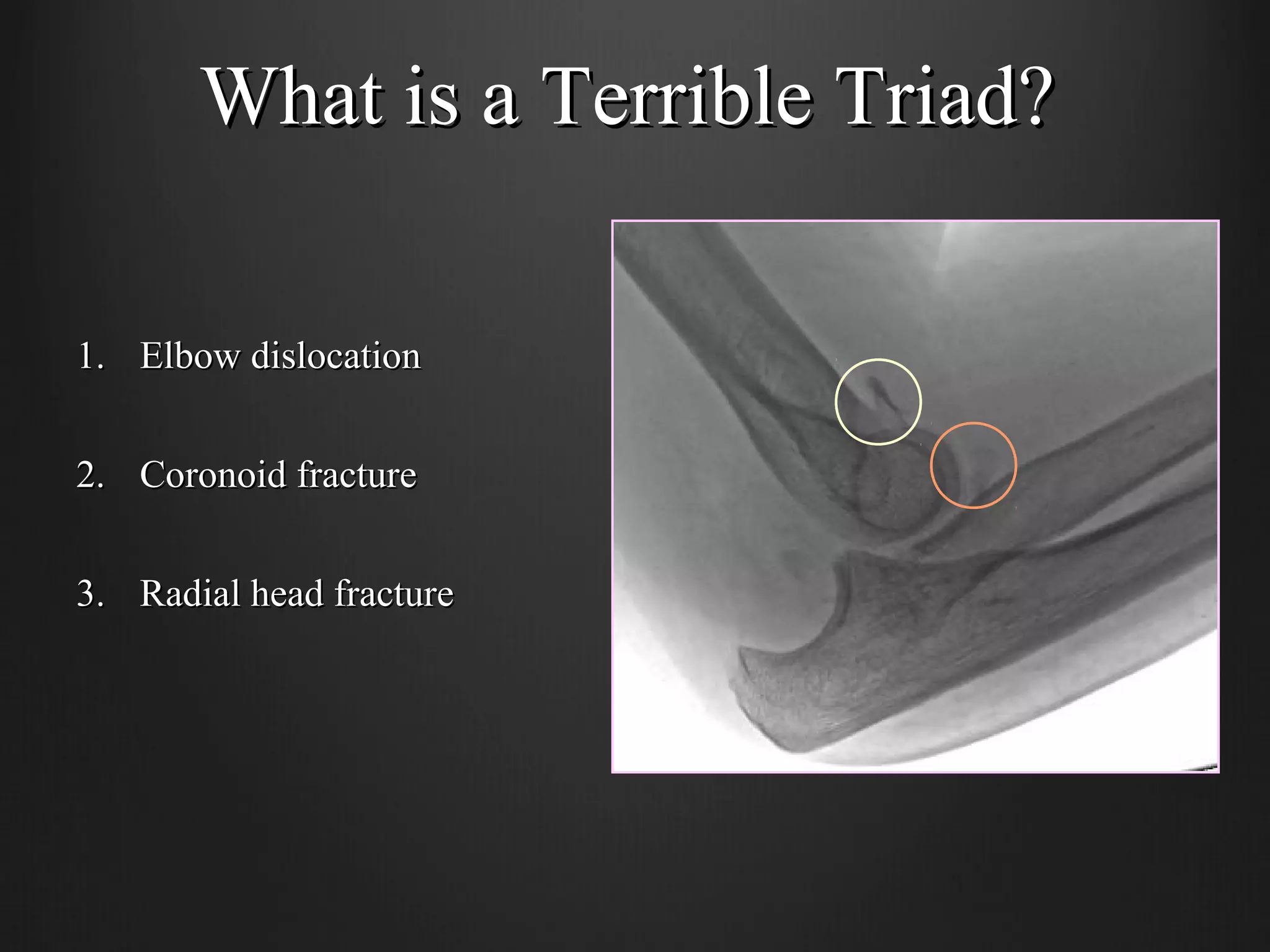 Terrible triad injuries - Hussain Algawahmed | PPT