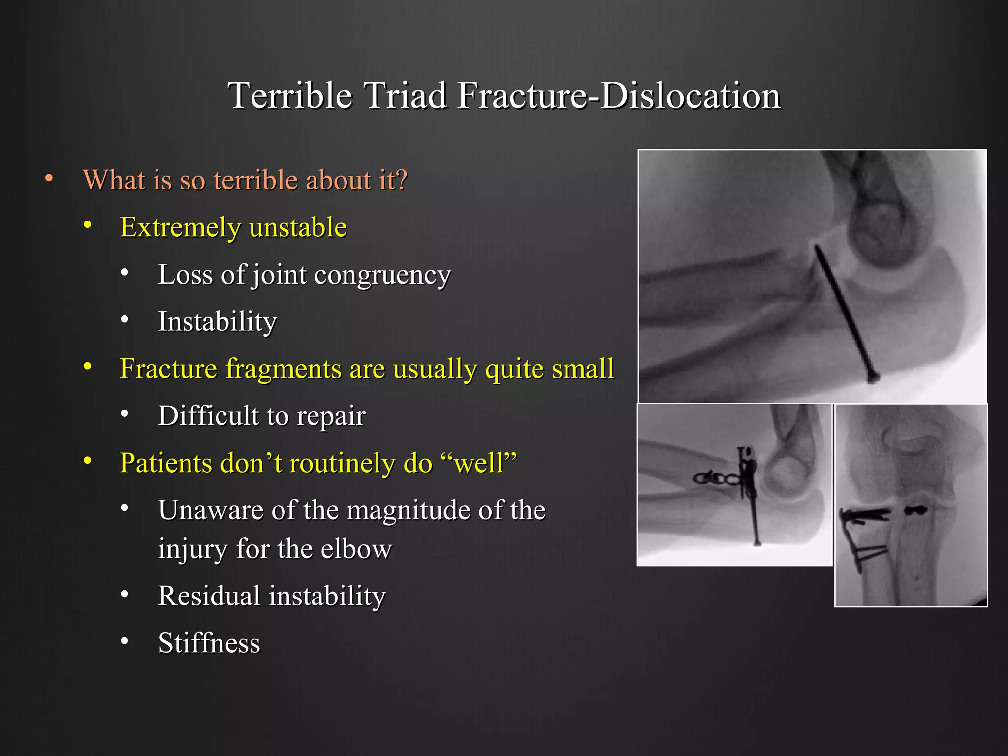 Terrible triad injuries - Hussain Algawahmed | PPT