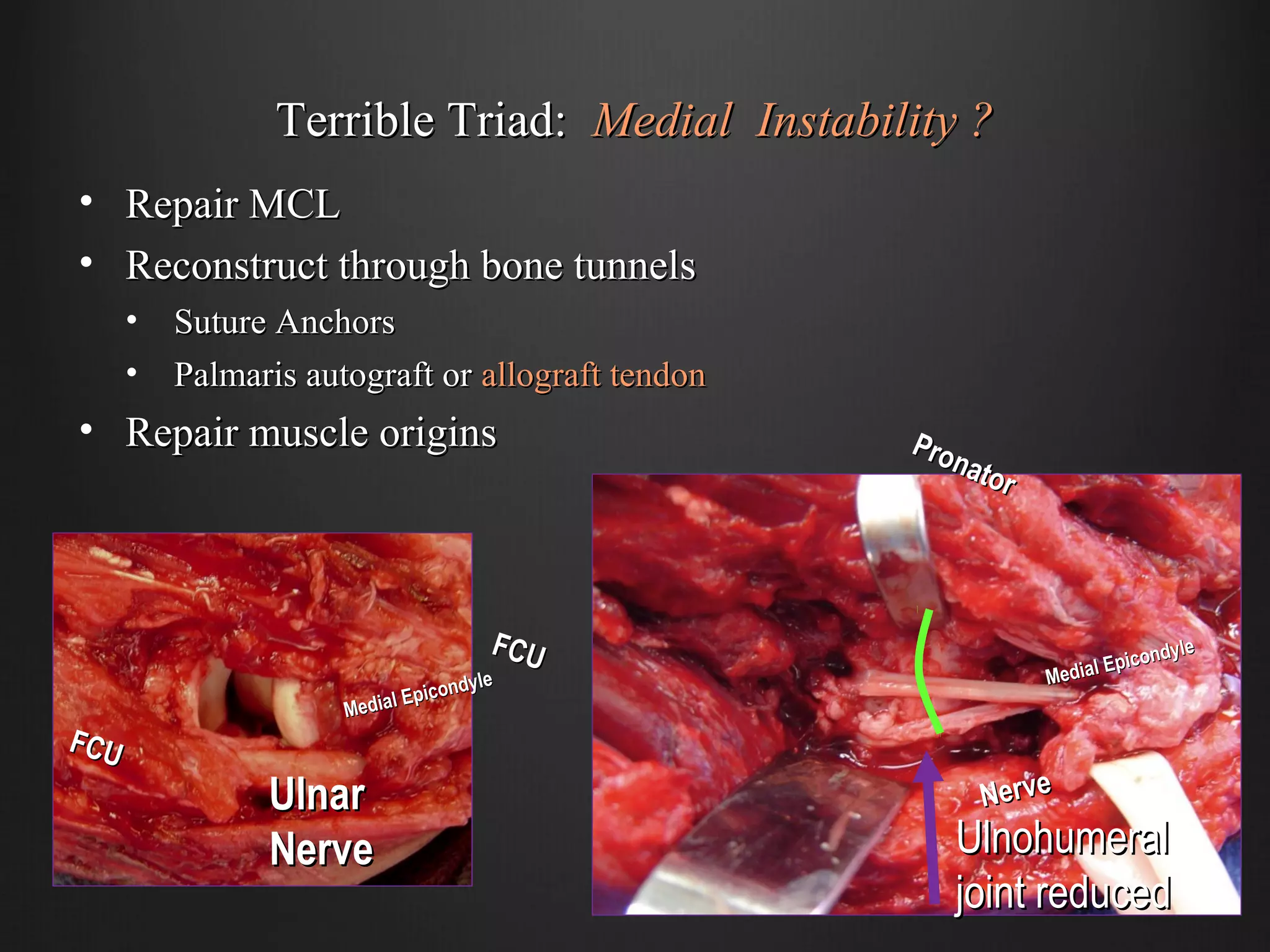 Terrible triad injuries - Hussain Algawahmed | PPT
