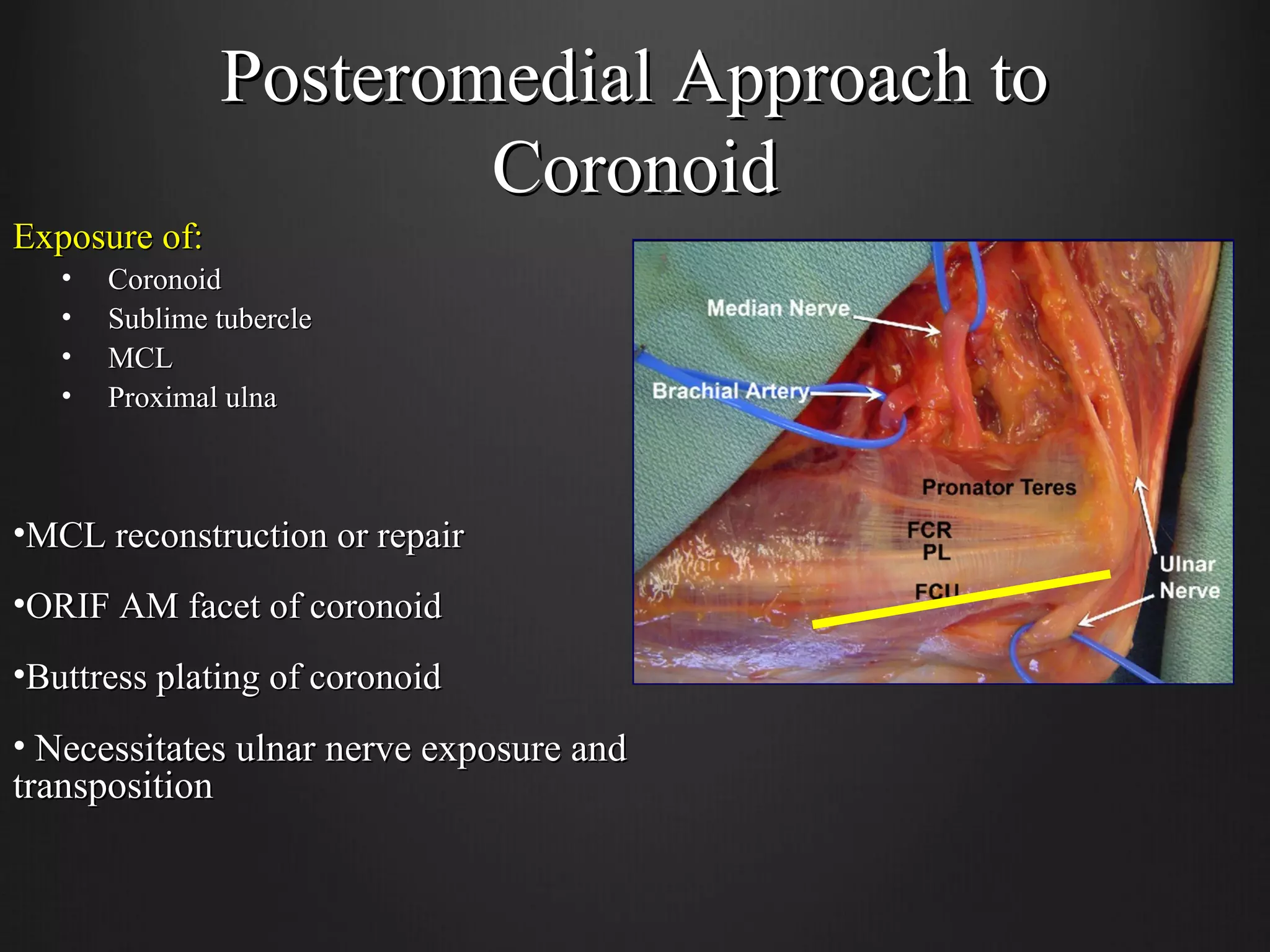 Terrible triad injuries - Hussain Algawahmed | PPT