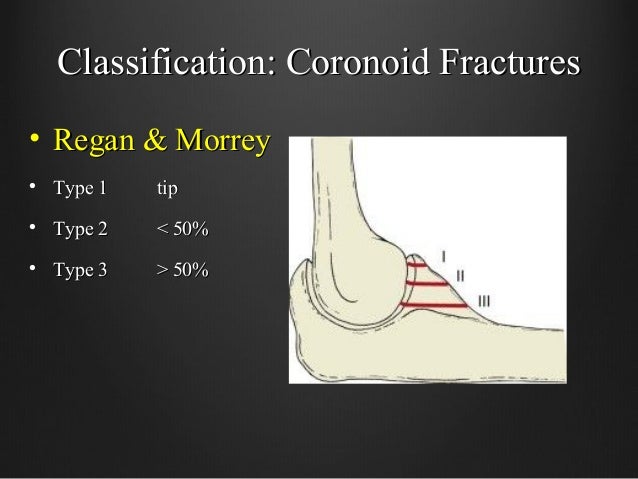 Terrible triad injuries - Hussain Algawahmed