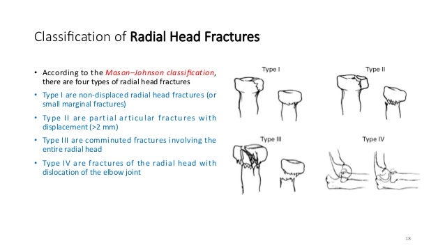 Radial Head Fracture Classification