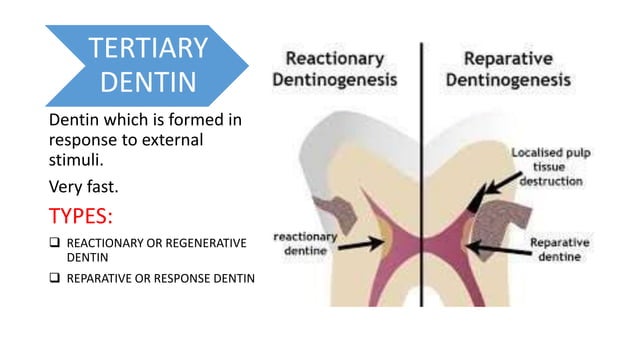 tertiary dentin types of tertiary dentin and histology | PPT
