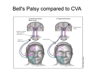Bell's Palsy Electrical Stimulation Treatment | PPT
