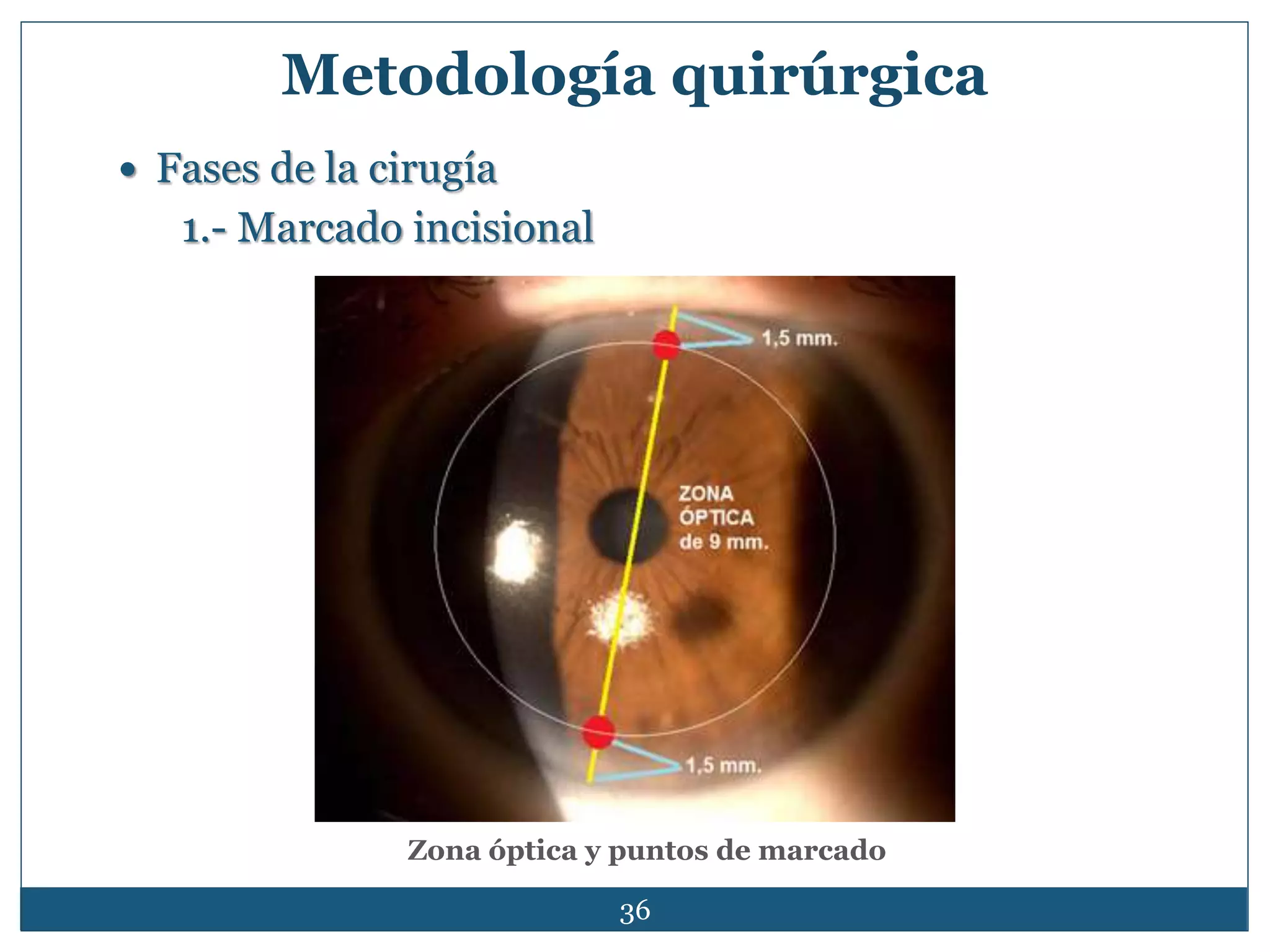 Incisiones corneales penetrantes en cirugía de cataratas | PPTX