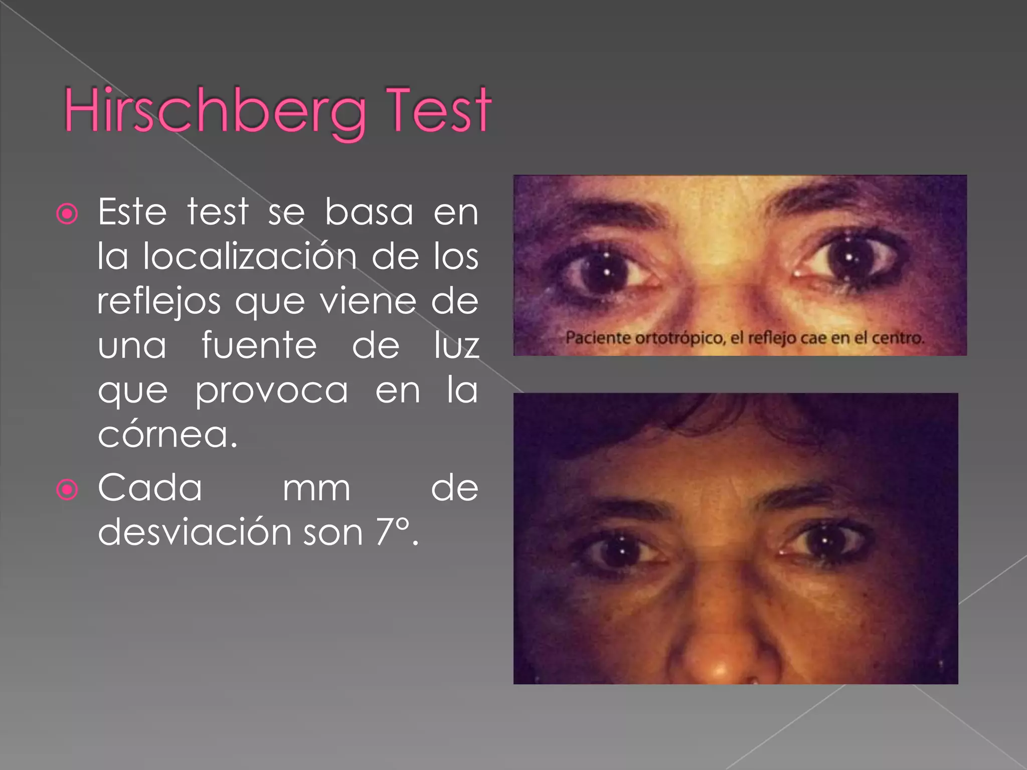 Test de hirschberg | PPT