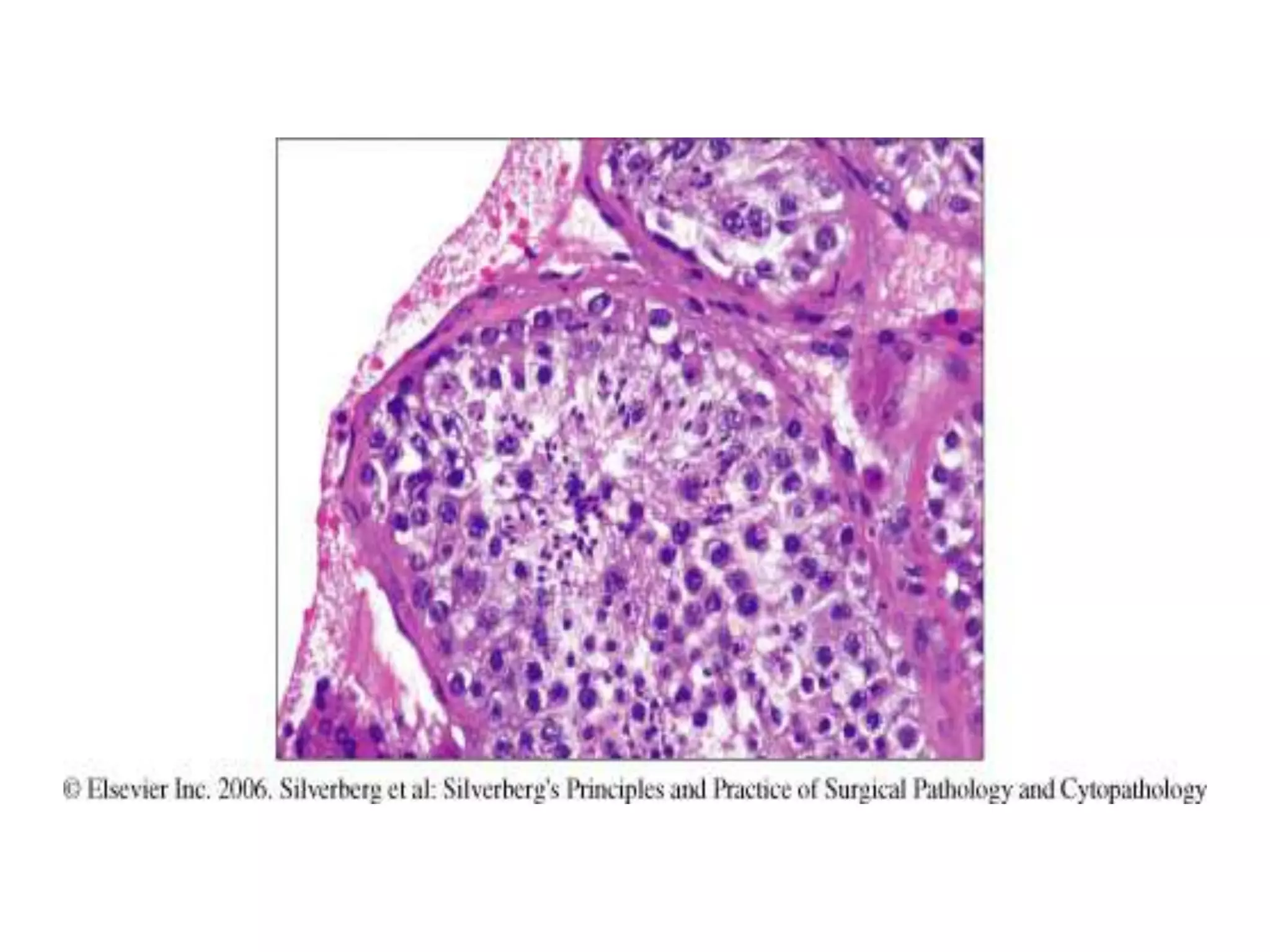 Testicular biopsy | PPTX