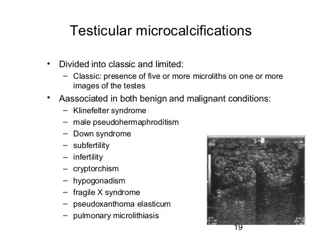 Testicular ca [edmond]