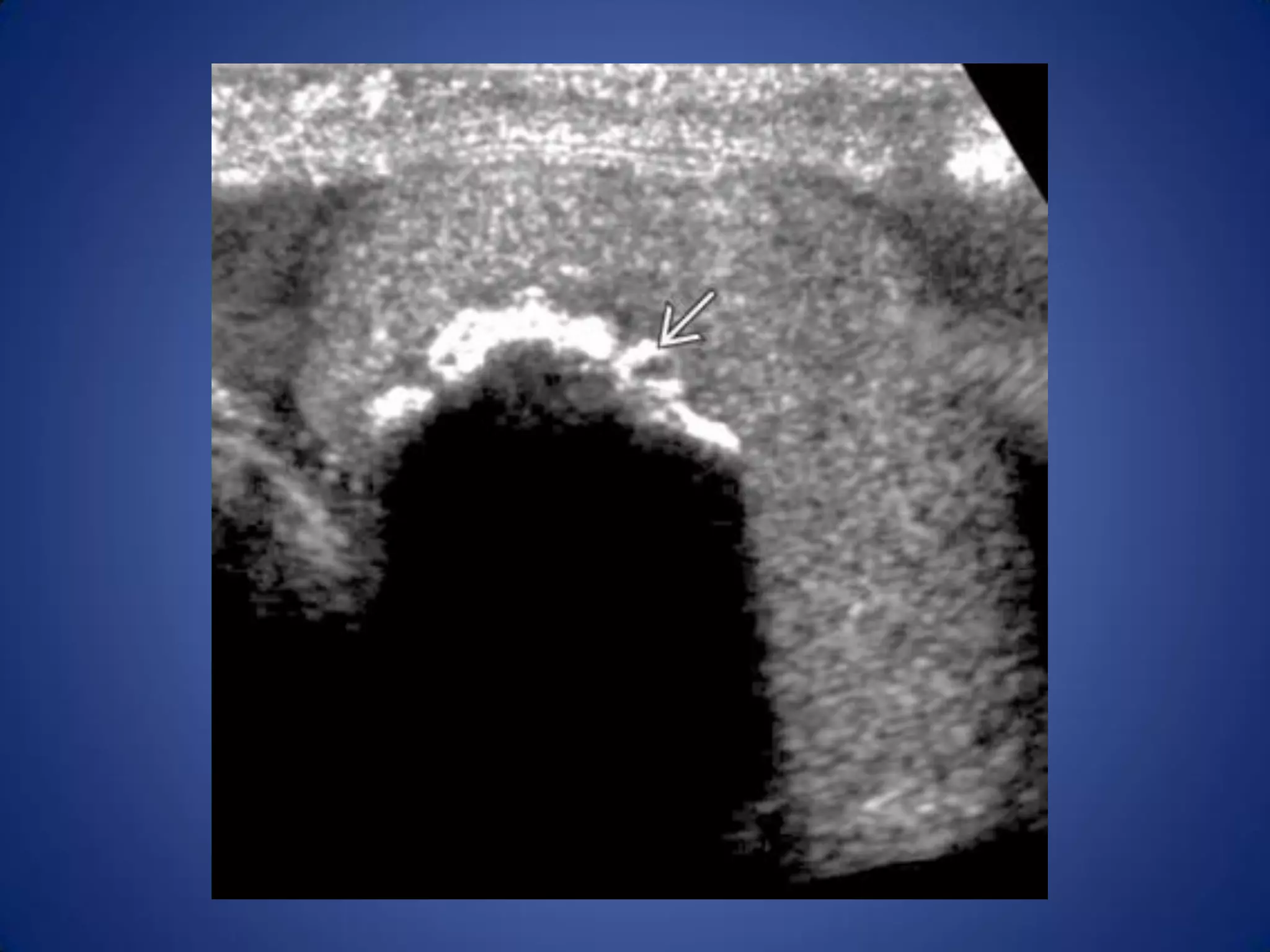 Testicular calcifications | PDF