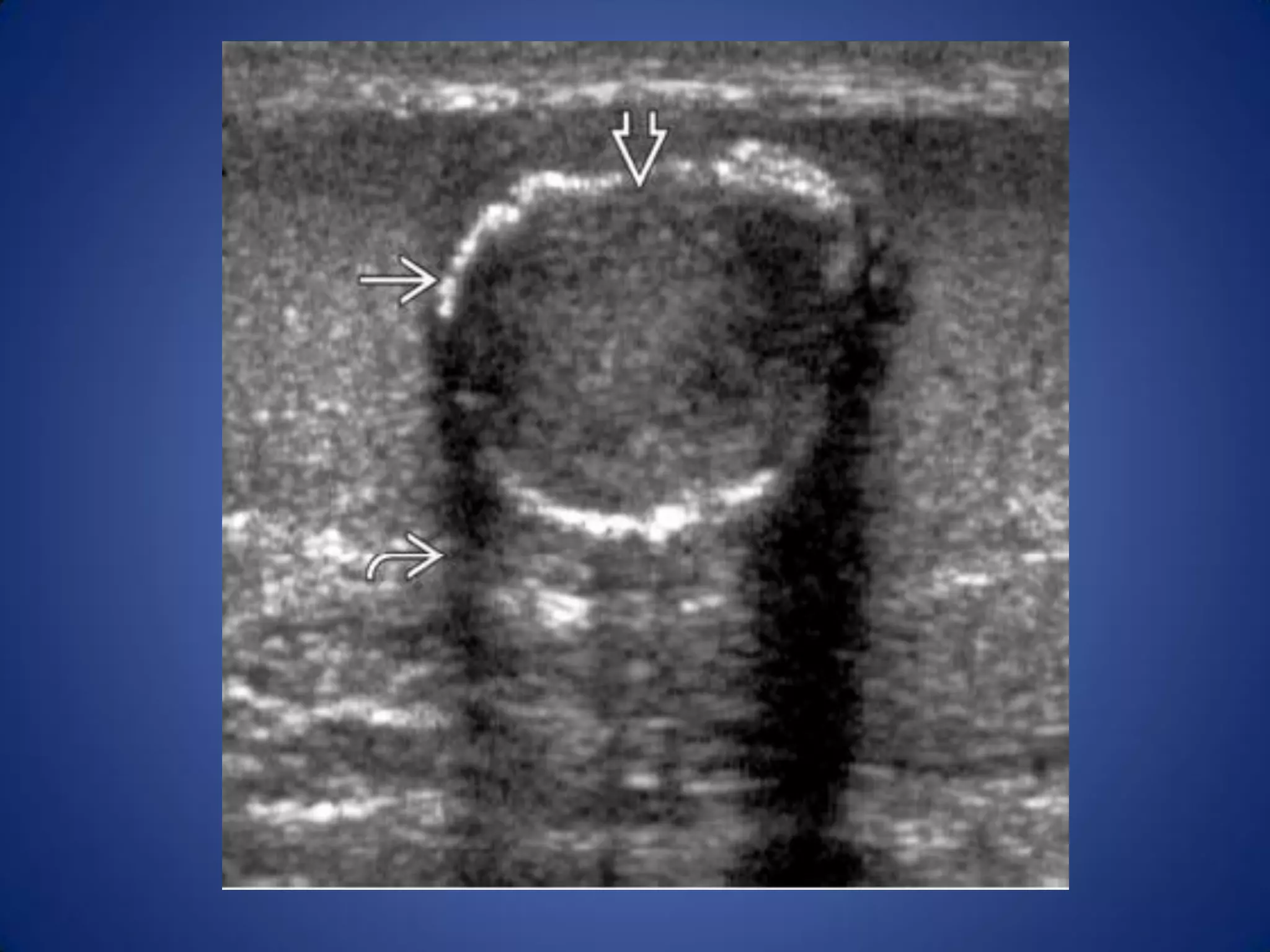 Testicular calcifications | PDF