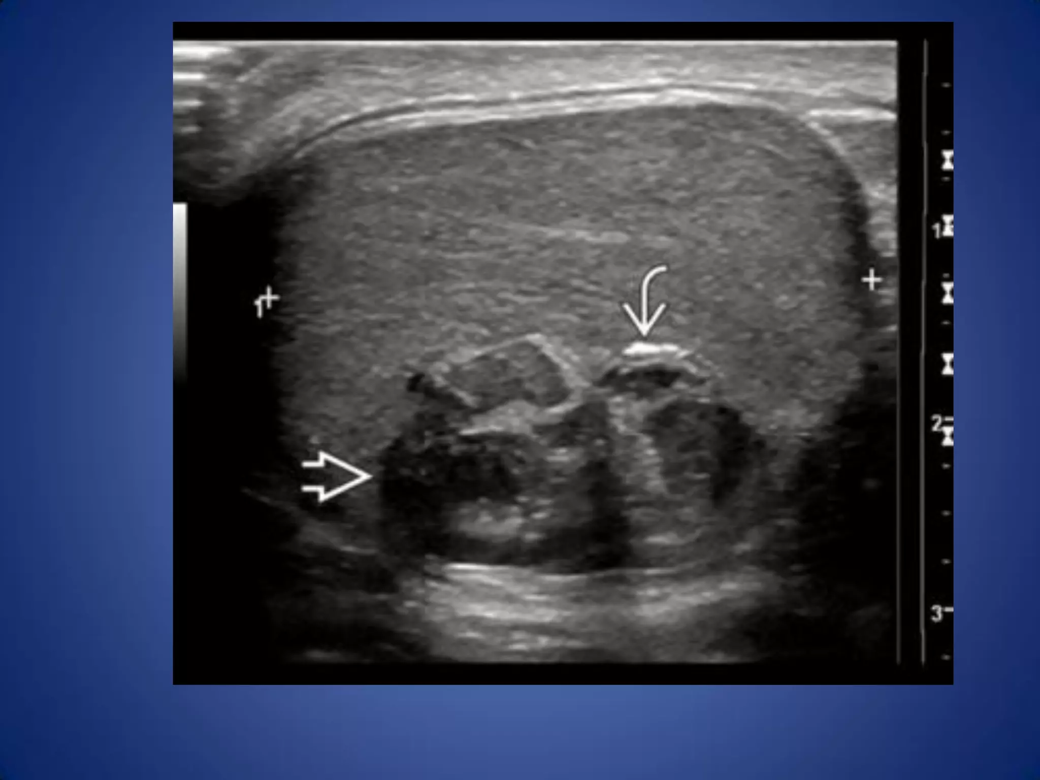 Testicular calcifications | PDF
