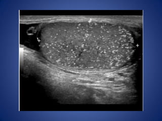 Testicular calcifications | PDF