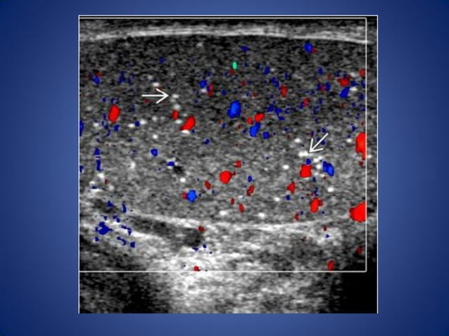 Testicular calcifications | PDF