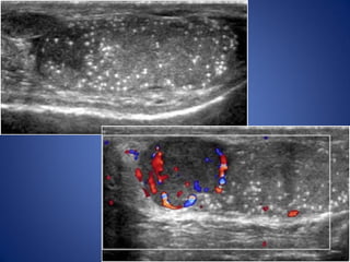 Testicular calcifications | PDF
