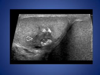 Testicular calcifications | PDF