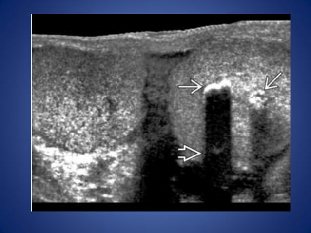 Testicular calcifications | PDF