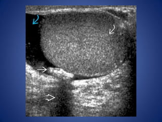 Testicular calcifications | PPT