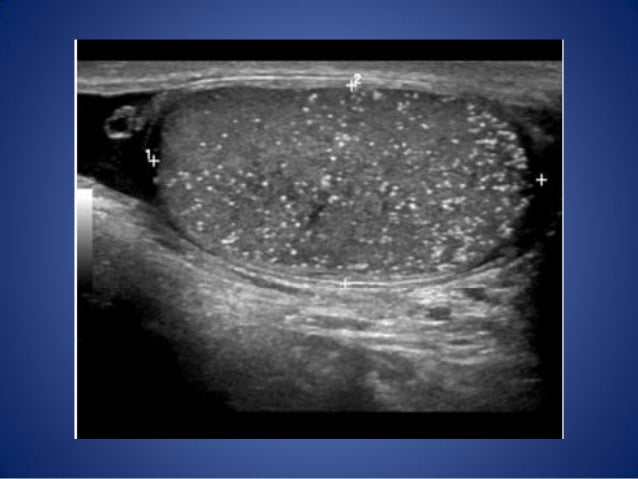 Testicular calcifications