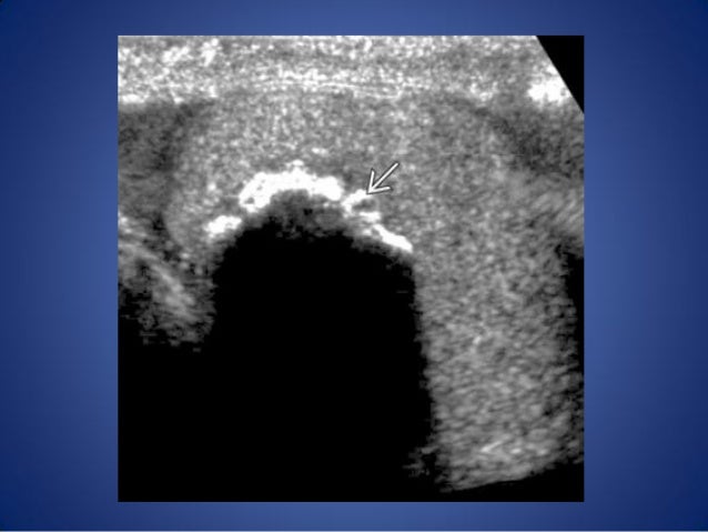 Testicular calcifications