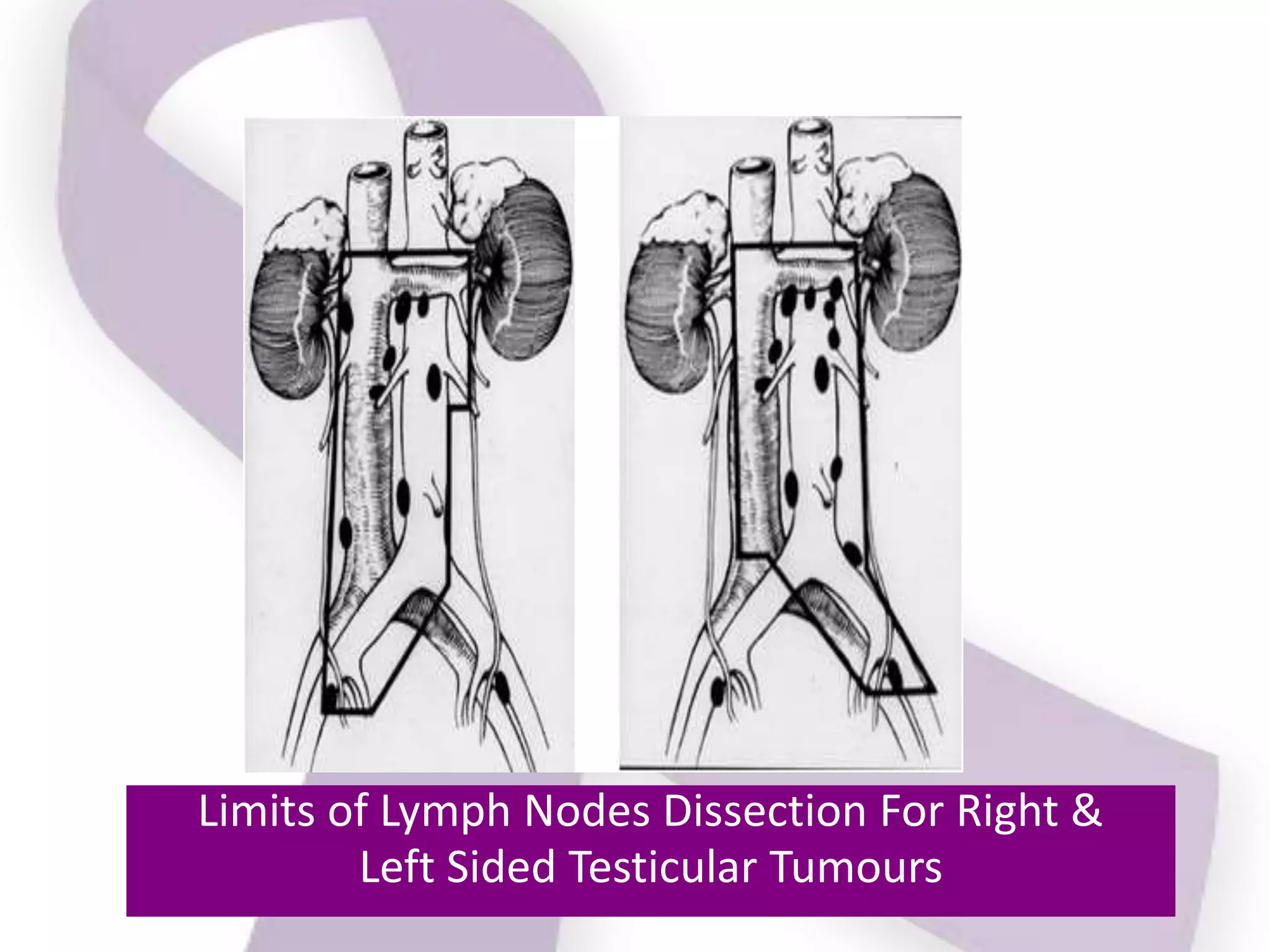 TESTICULAR CANCER.pptx
