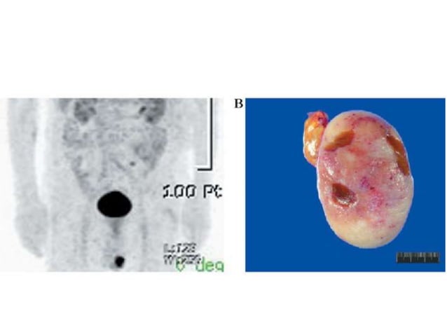 Testicular lymphoma | PPTX | Cancer | Diseases and Conditions