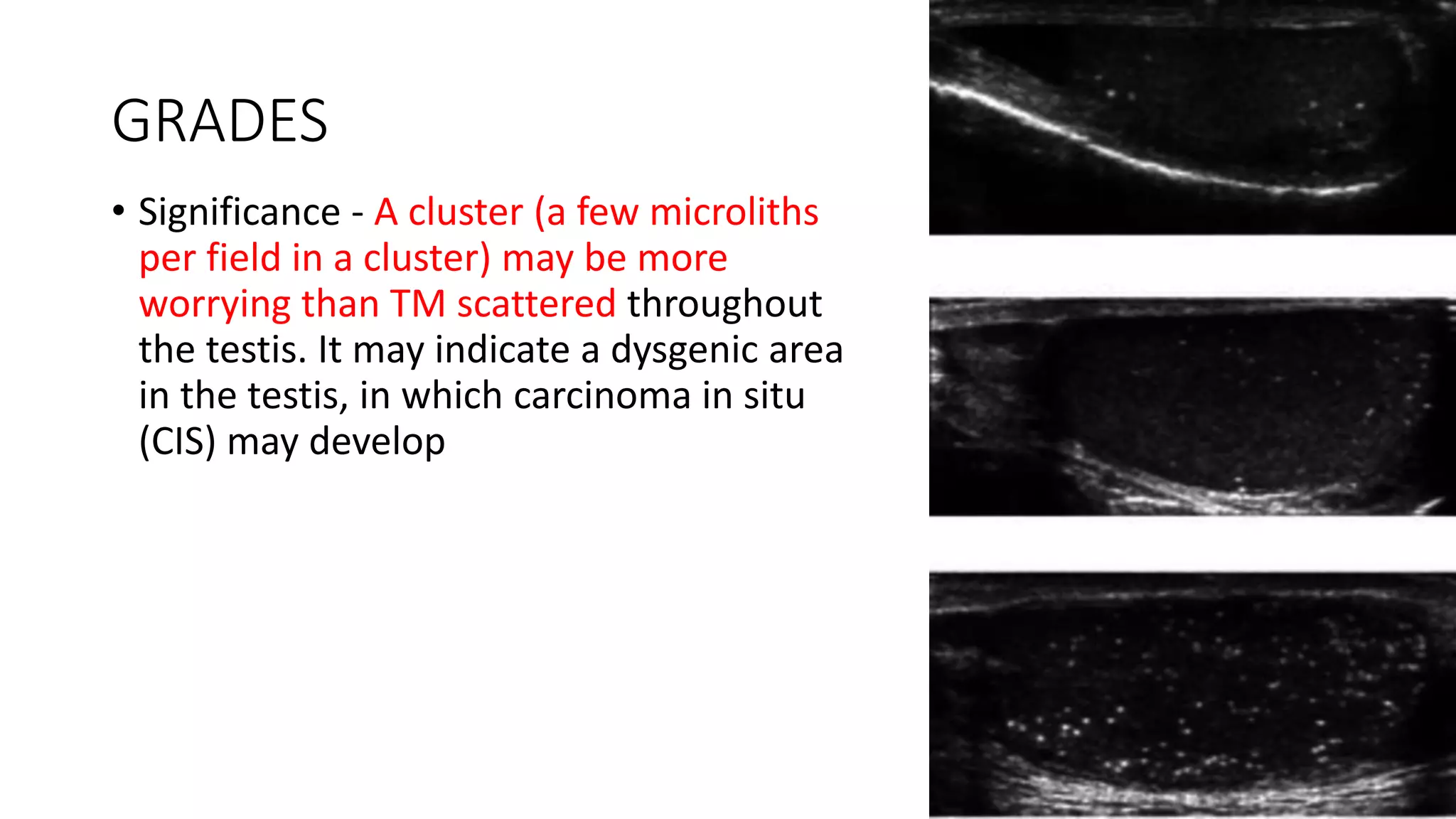 Testicular Microlithiasis Pptx