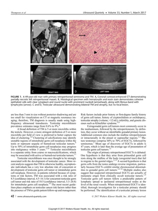 Testicular microlithiasis in the setting | PDF