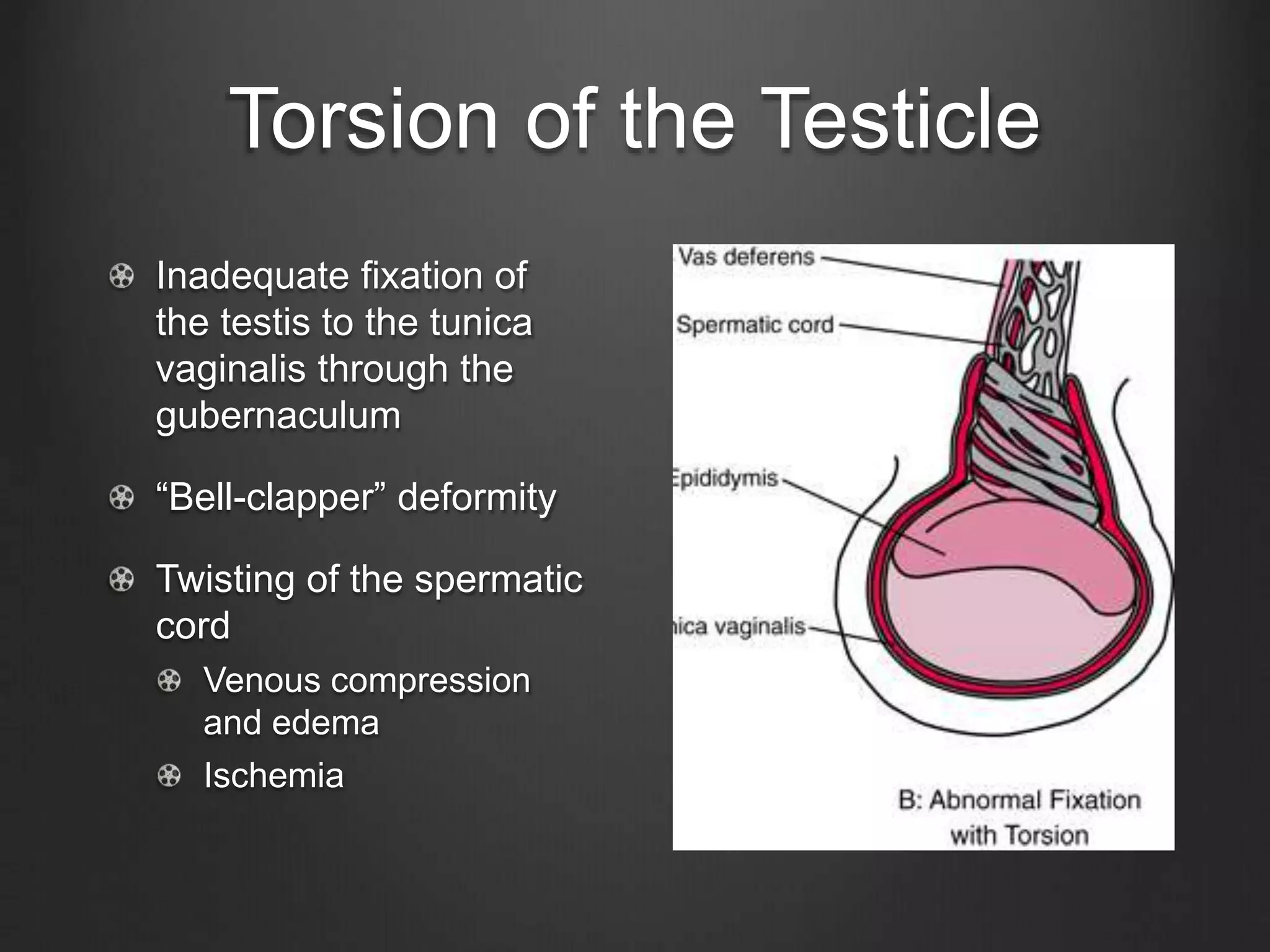 Testicular pain in emergency | PPTX