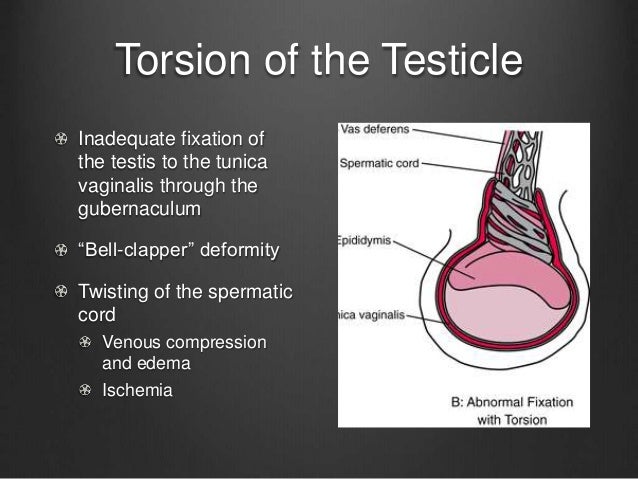 Testicular pain in emergency