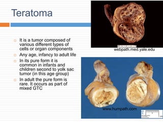 Testicular pathology, sufia husain, 2018 | PPTX