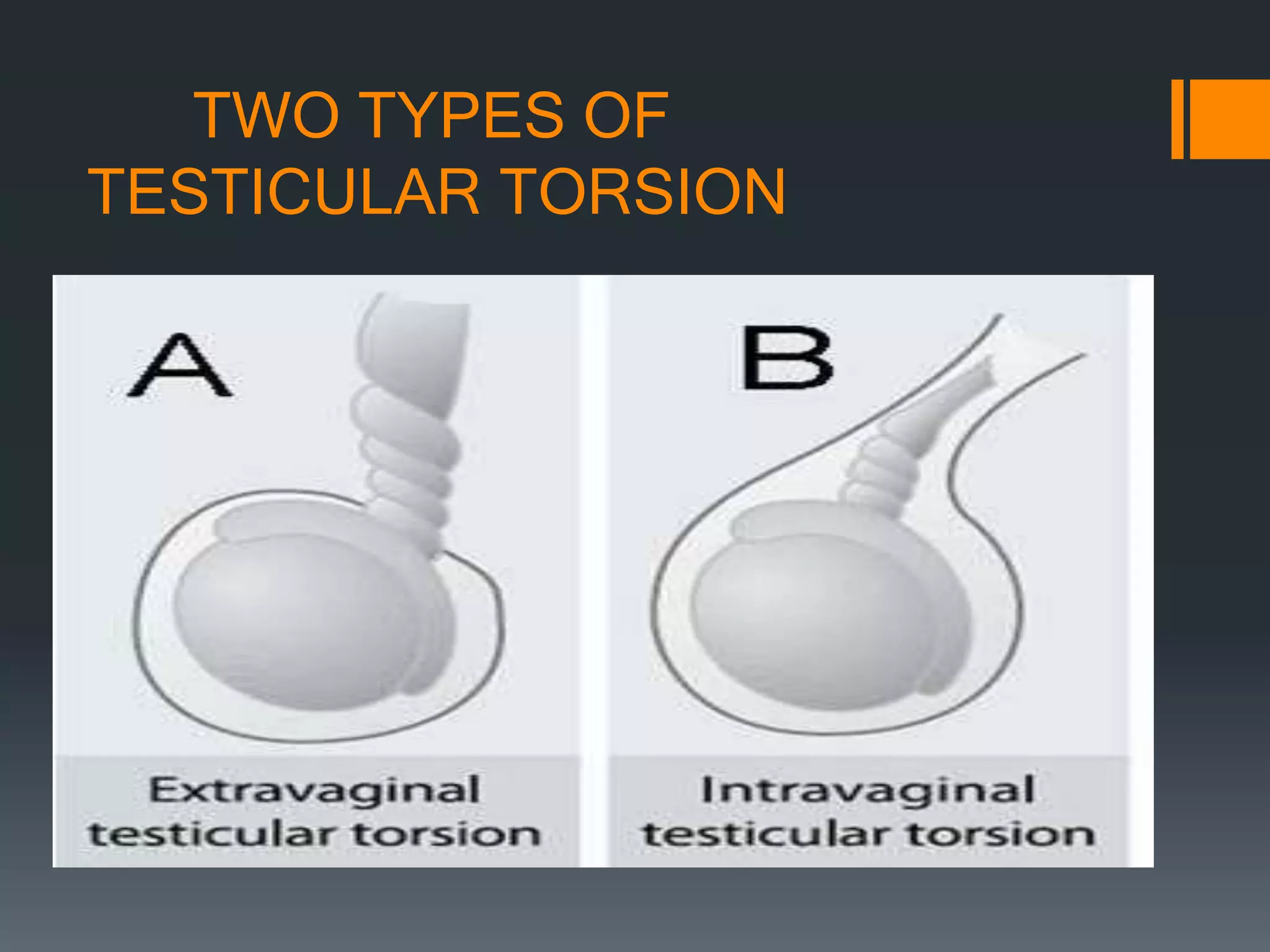 TESTICLULAR TORSION PPTX