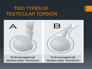 Testicular Torsion Intravaginal