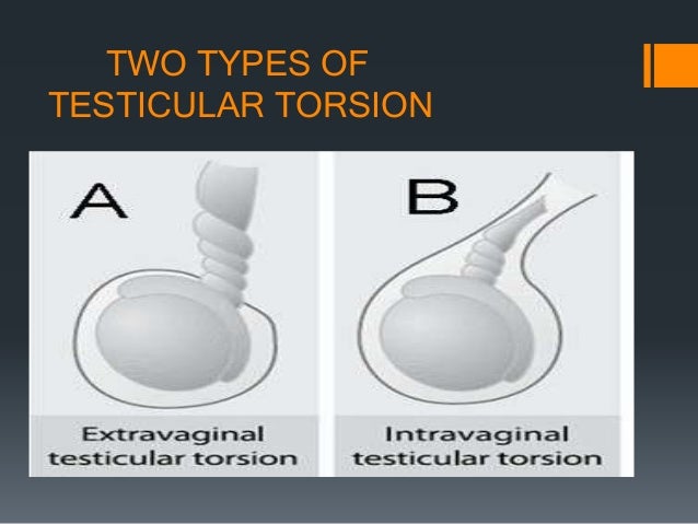Types Of Testicular Torsion