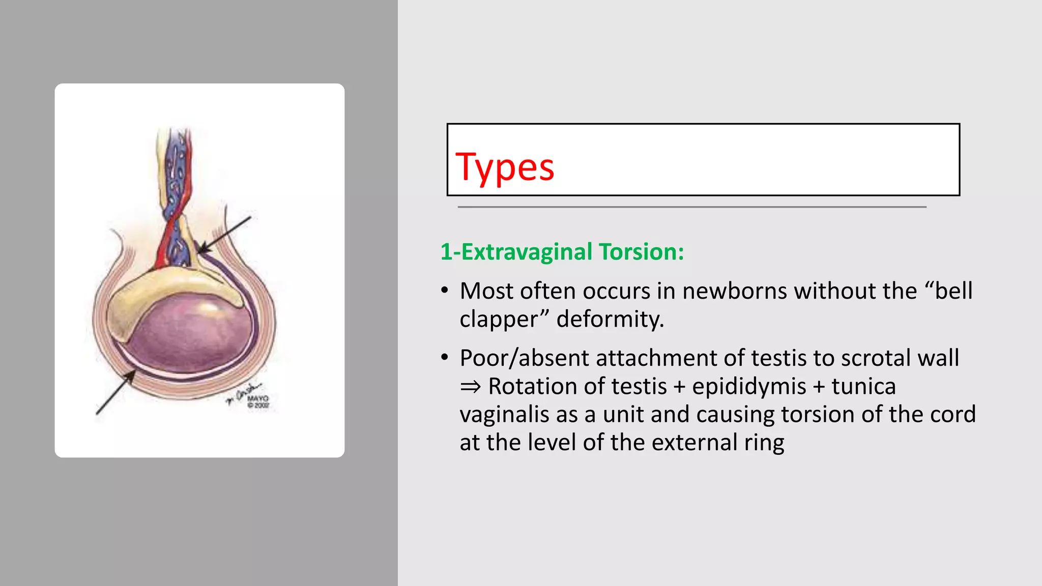 Testicular Torsion - Pediatrics Surgery | PPTX