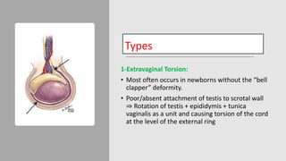 Testicular Torsion - Pediatrics Surgery | PPT