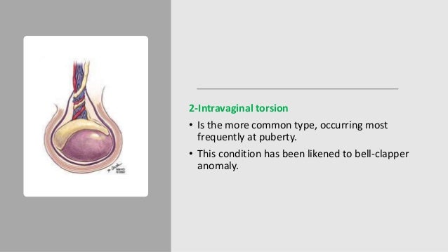 Testicular Torsion Pediatrics Surgery