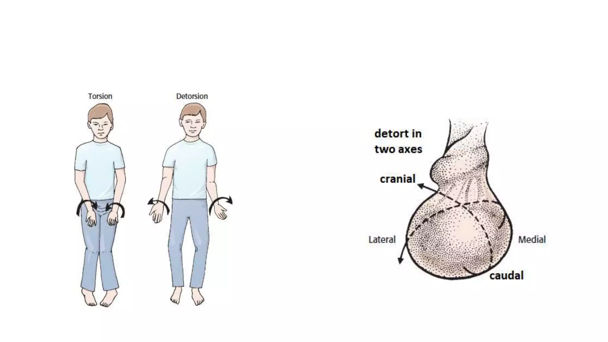 Testicular torsion.pptx