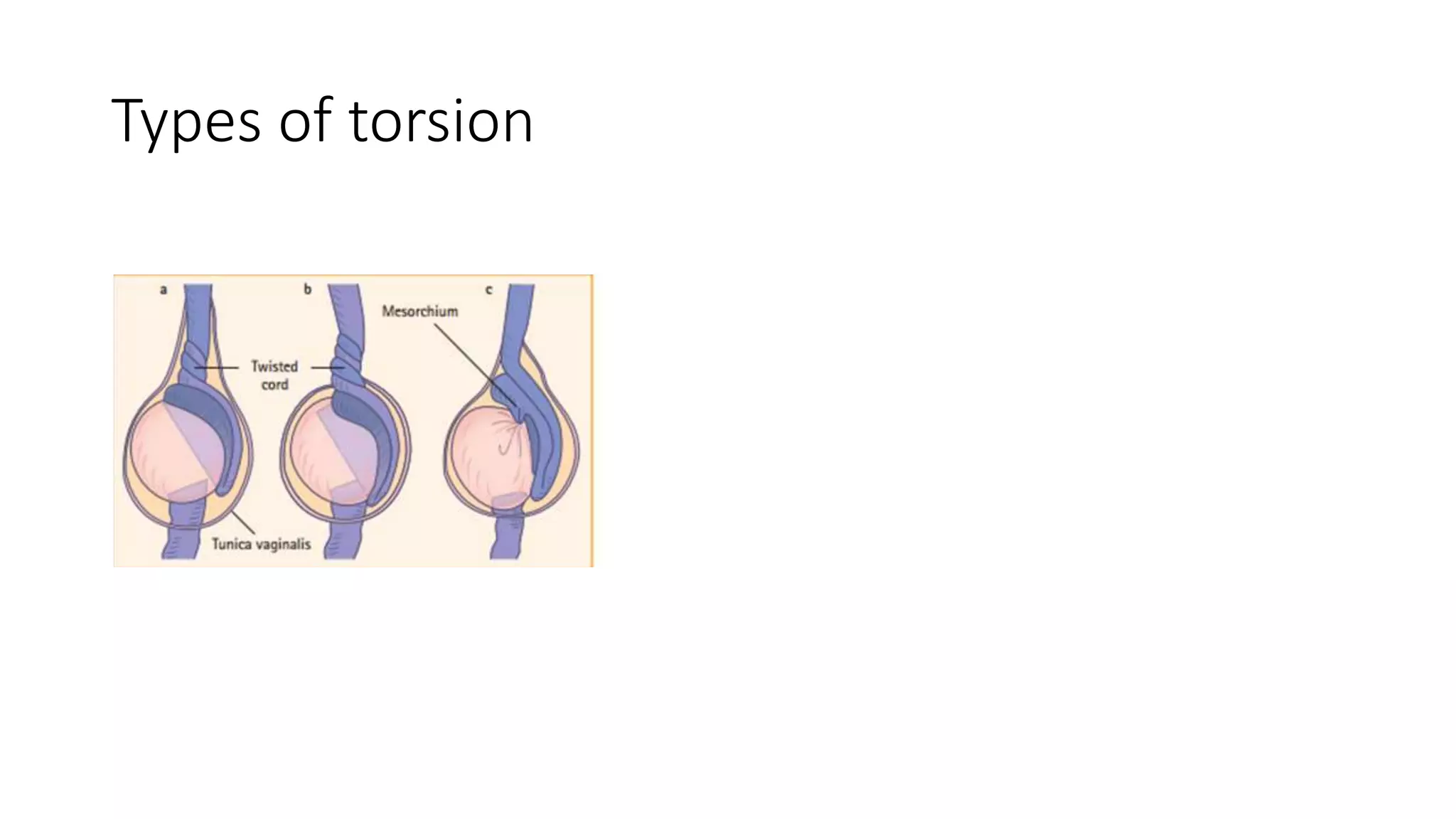 Testicular Torsion pptx