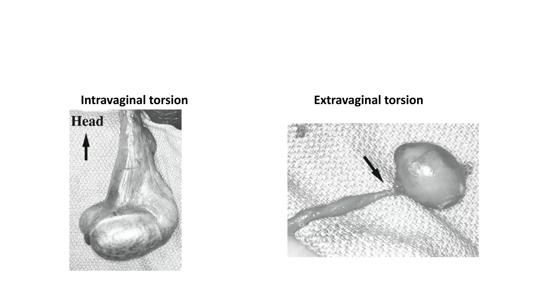 Testicular torsion.pptx