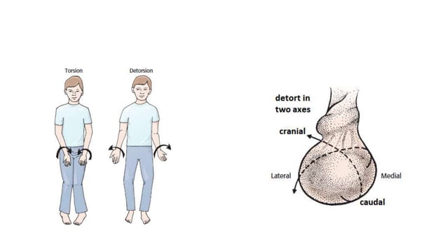 Testicular torsion.pptx | Reproductive Health | Diseases and Conditions