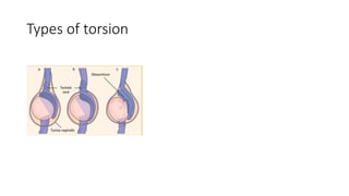 Testicular torsion.pptx