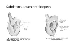 Testicular torsion.pptx