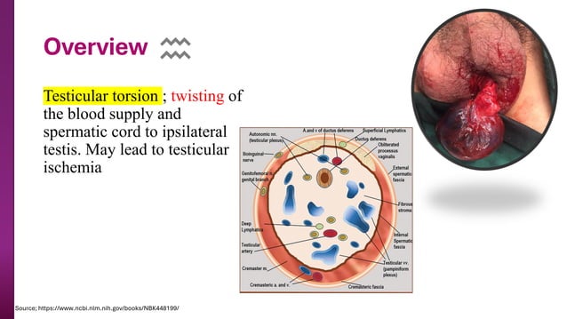 Testicular Torsion scrotal emergency.pdf