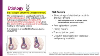 Testicular Torsion scrotal emergency.pdf
