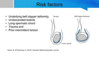 Intermittent Testicular Torsion